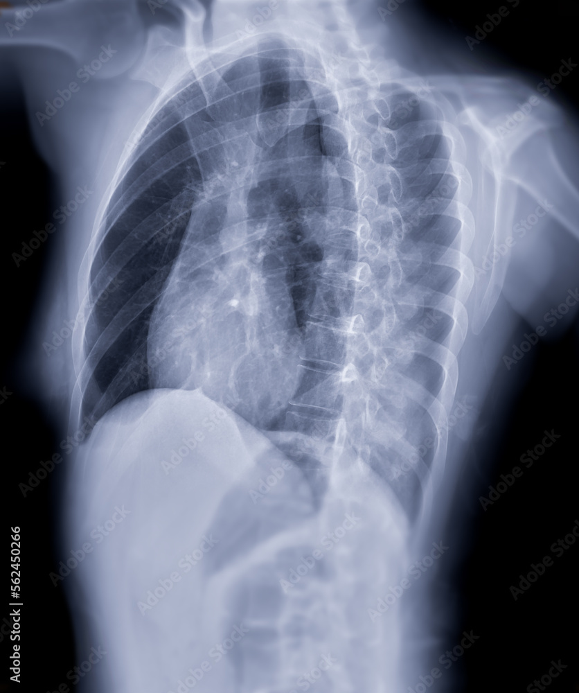 Chest x-ray image oblique view for screening diagnosis TB,tuberculosis ...