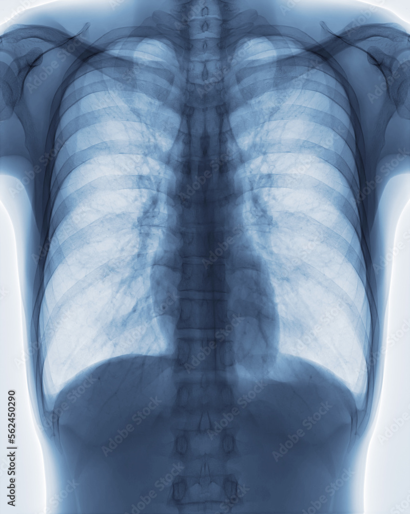 Chest x-ray image for screening diagnosis TB,tuberculosis and covid-19 ...