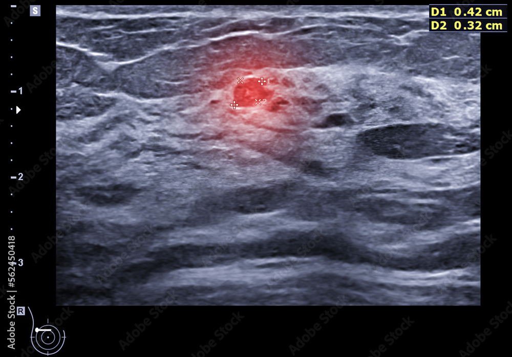 ultrasound breast of Patient after mammogram for diagnonsis Breast ...