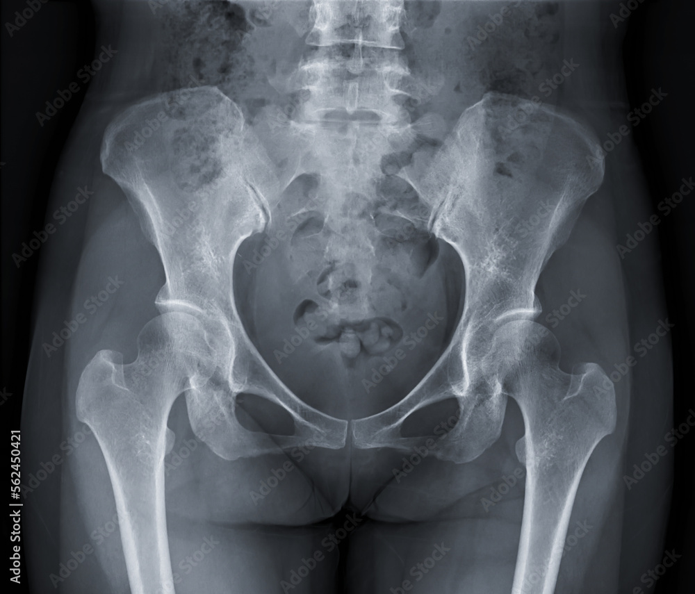 X-ray image of Pelvic bone. Stock Photo | Adobe Stock