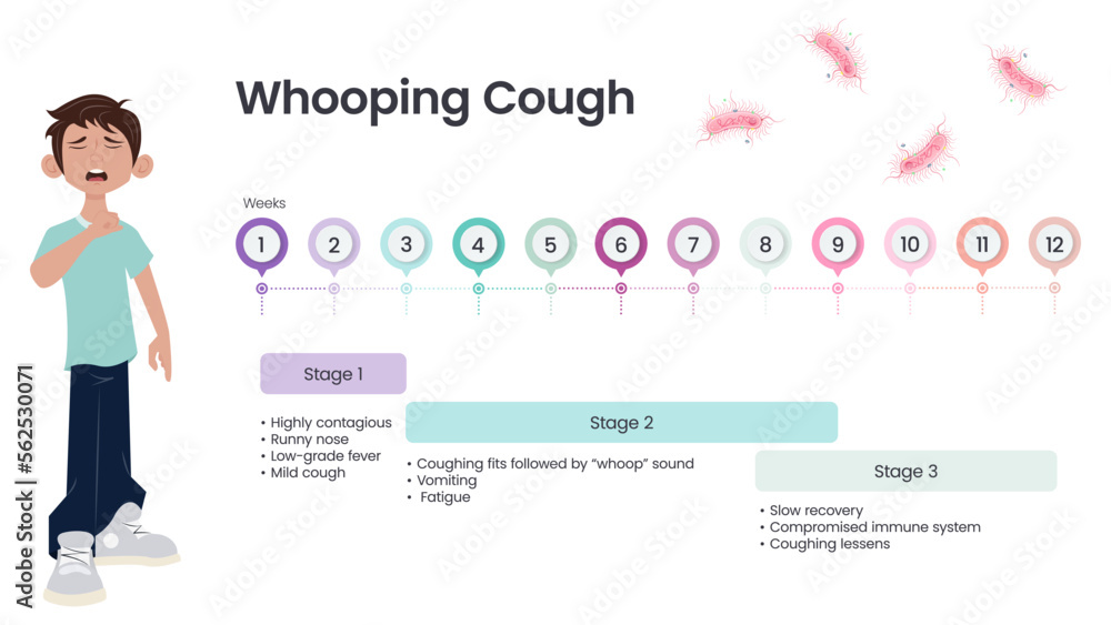 Whooping Cough Pertussis Symptom Timeline vector illustration ...