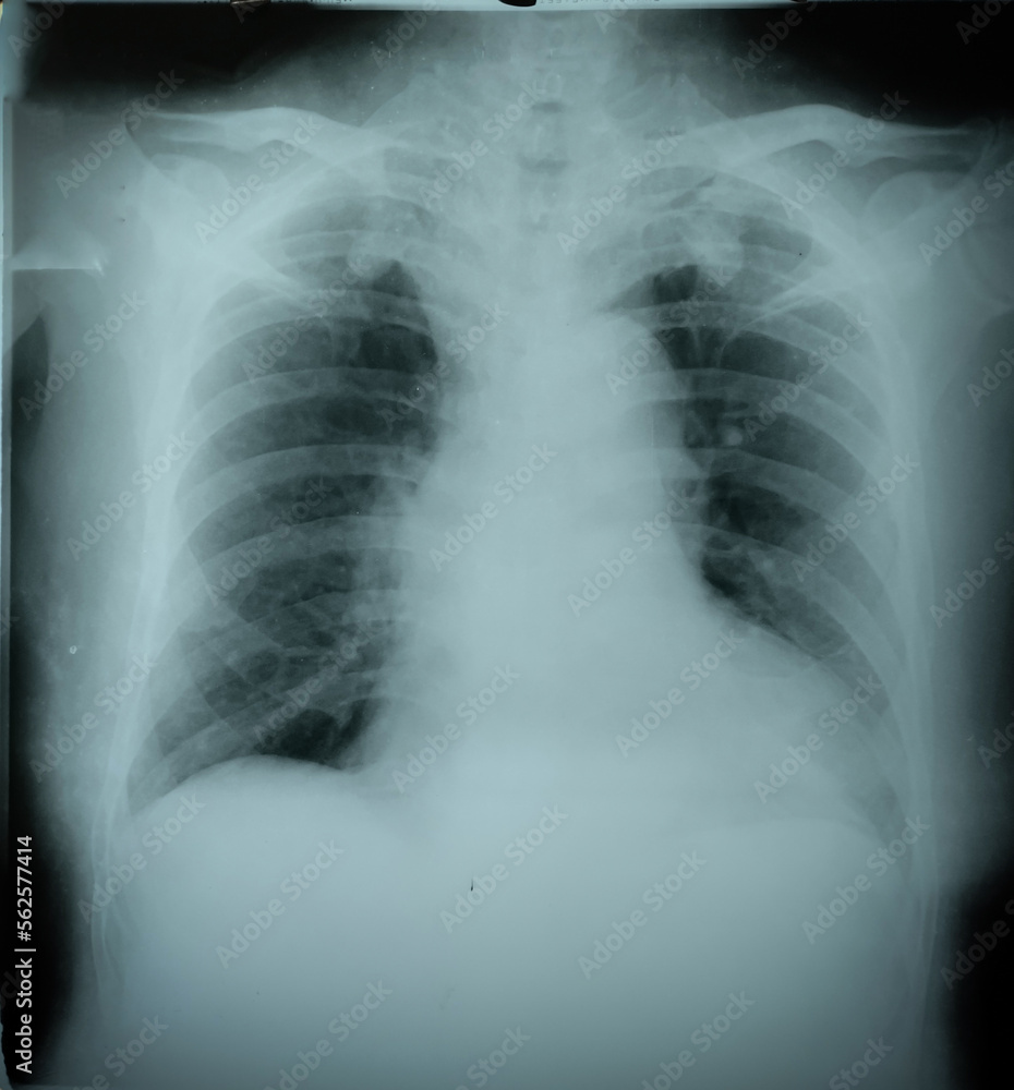 Chest X Ray of an elderly man with an enlarged heart Stock Photo ...