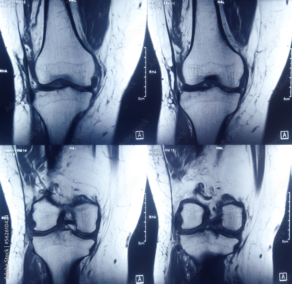 Knee joint x-ray or CT scan. Doctor pointed on area of knee joint ...