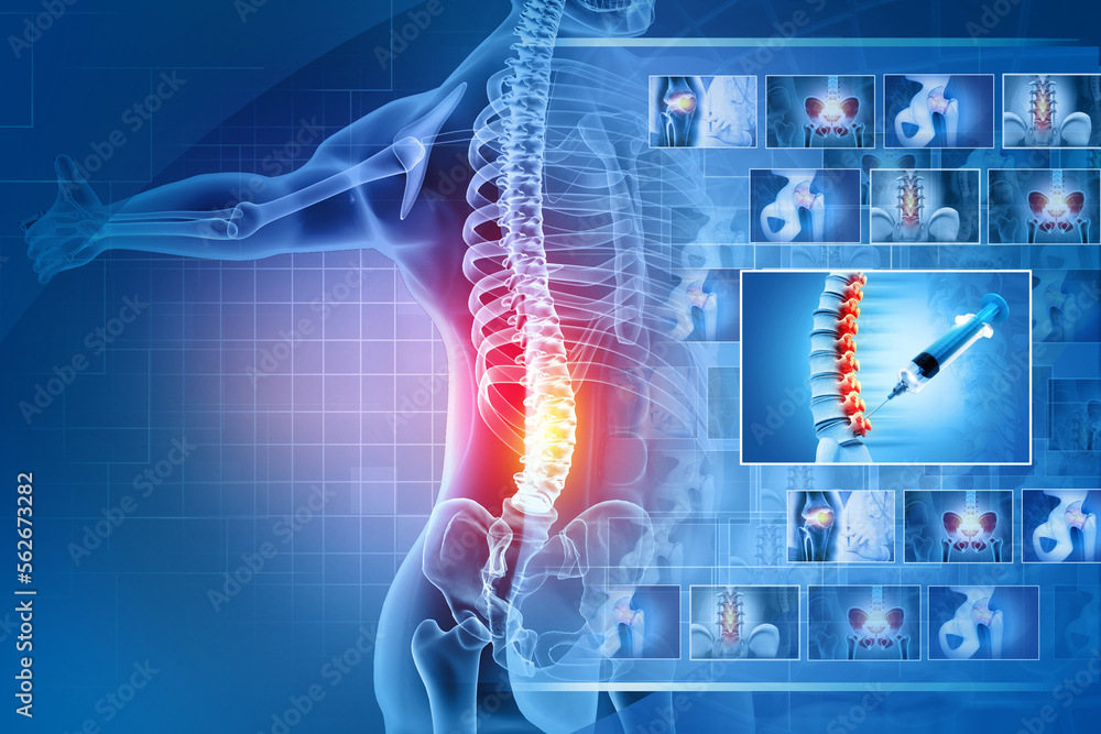 pain in the spine, pain in the back, lumbar spine injection ...