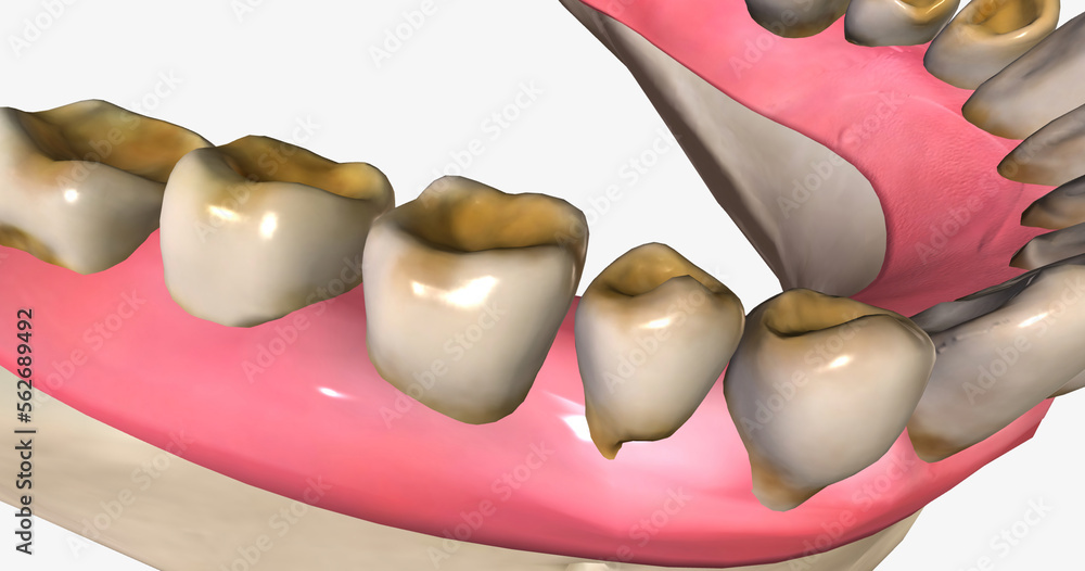 Dental erosion, also known as tooth erosion Stock Illustration | Adobe ...