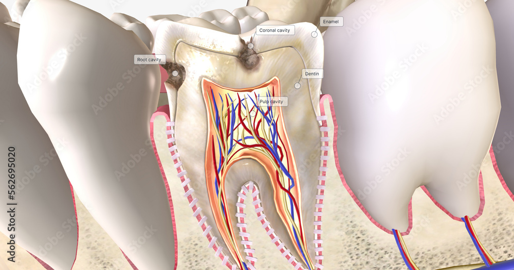 Dental caries, or cavities, are areas of tooth decay caused by acid ...