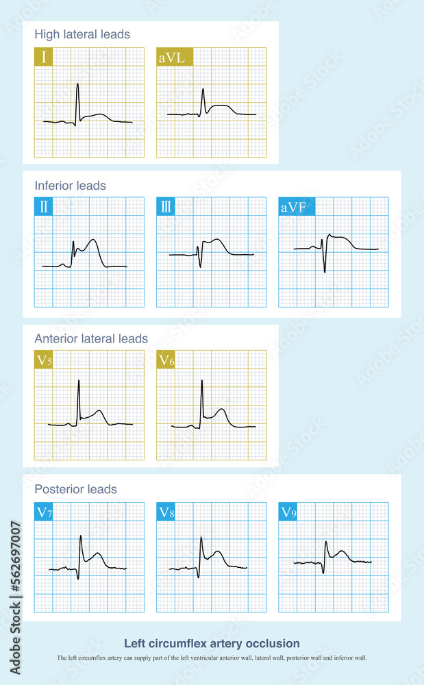 When the left circumflex artery is occluded, it can cause the ST ...