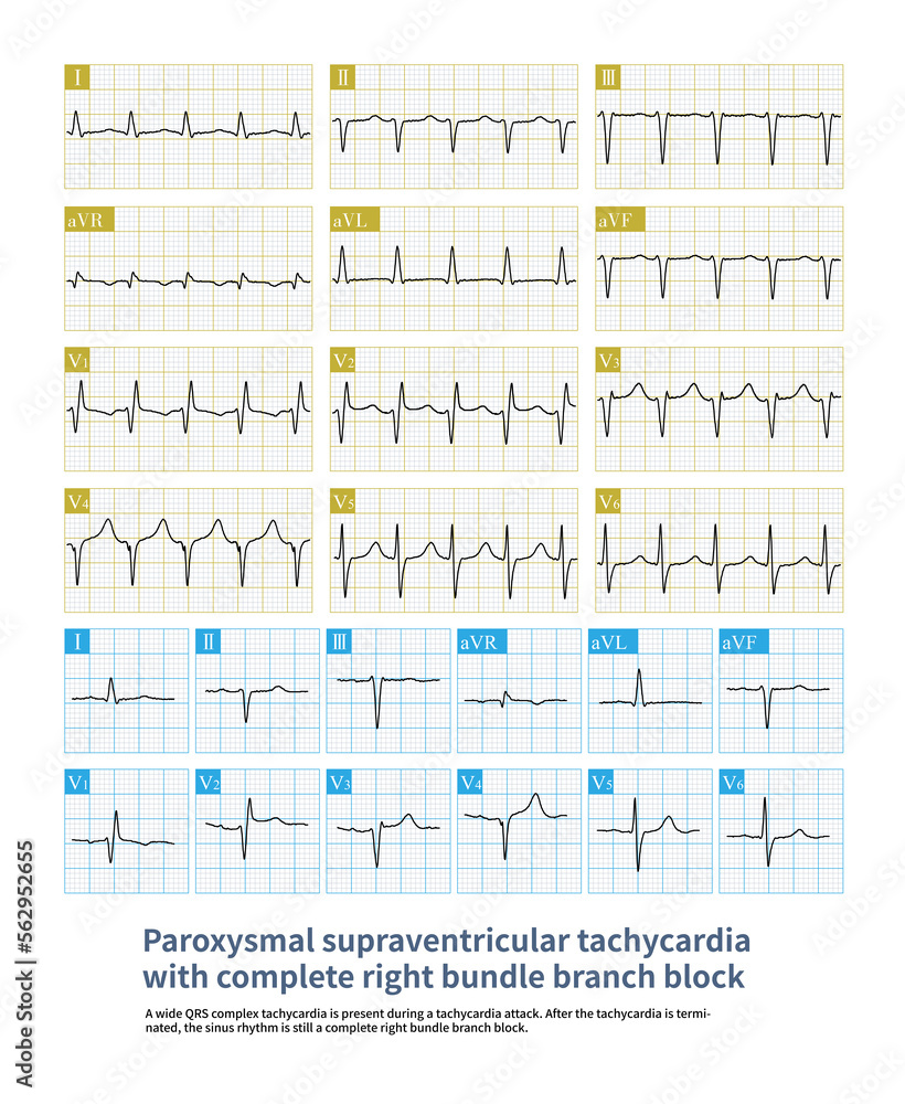 Sometimes, when supraventricular tachycardia is combined with bundle ...