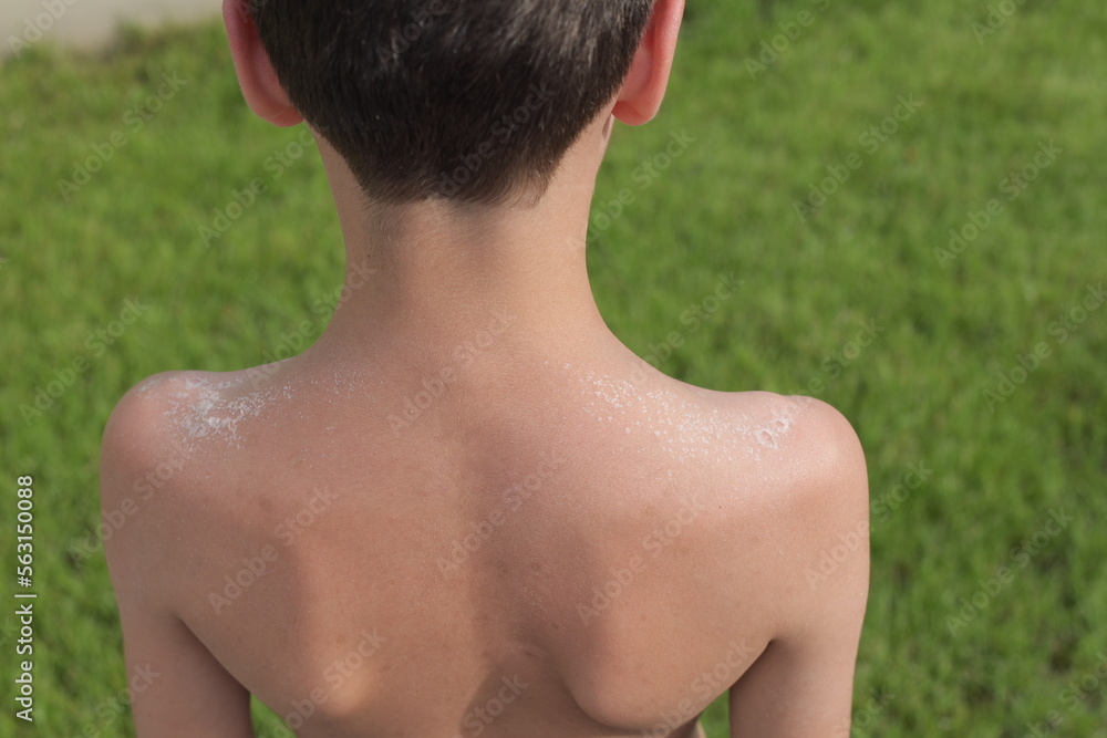 sunburn on the shoulder of a child, after a long time in the sun, the ...