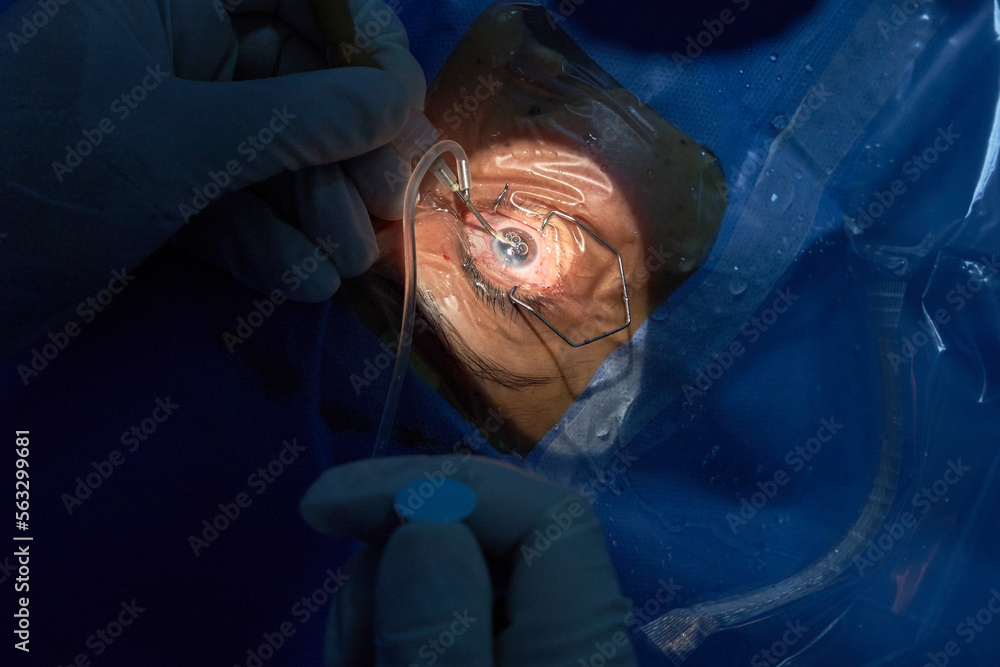 Phacoemulsification, destruction of the opaque lens by ultrasound ...