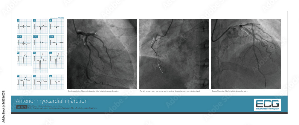In one young man with extensive anterior myocardial infarction ...
