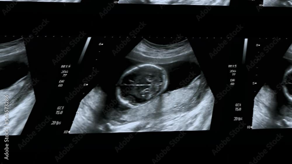 Multi screen ultrasound small baby at 12 weeks. 12 weeks pregnant ...