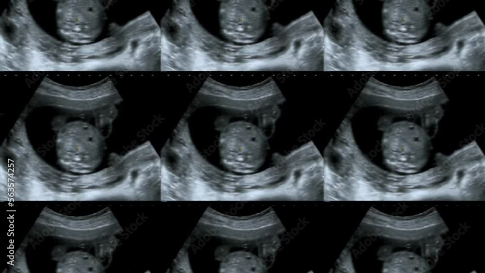 Multi screen ultrasound small baby at 12 weeks. 12 weeks pregnant ...