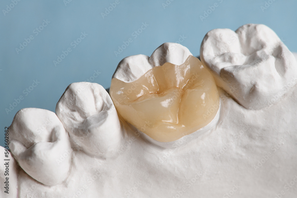 Keramik Teilkrone auf dem Model Stock Photo | Adobe Stock