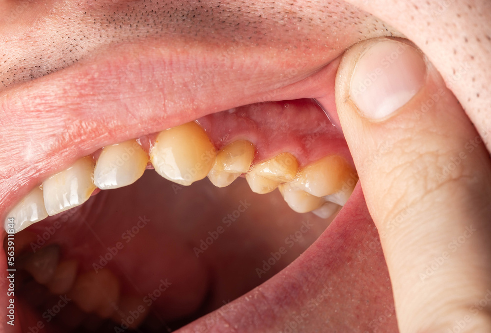 Restoration of decayed teeth. Dissected teeth in the patient's mouth ...