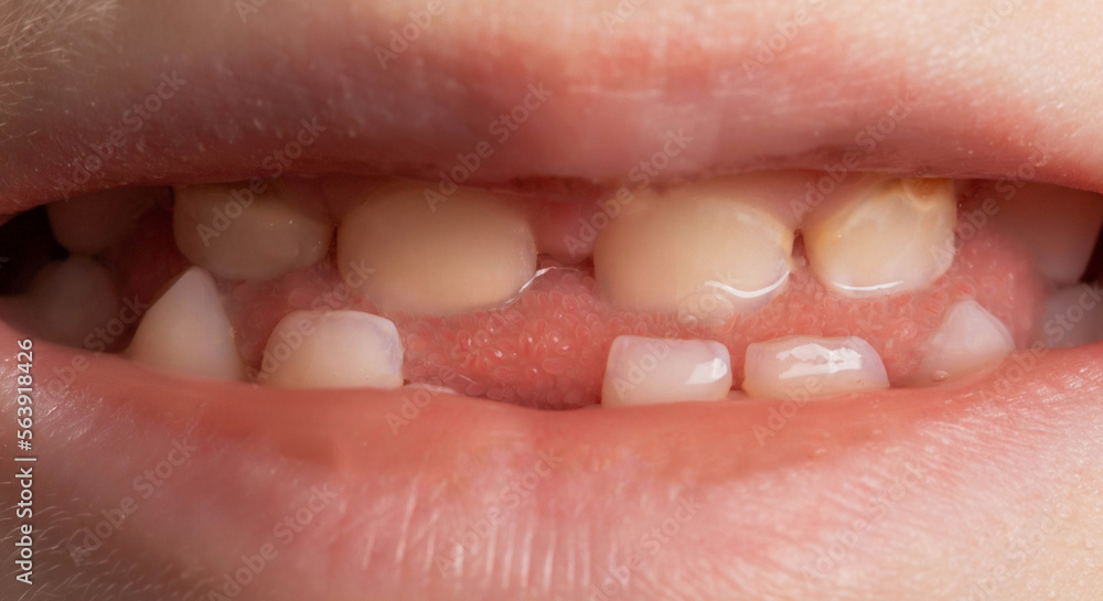 The smile of a child without one tooth in the jaw. Loss and removal of ...