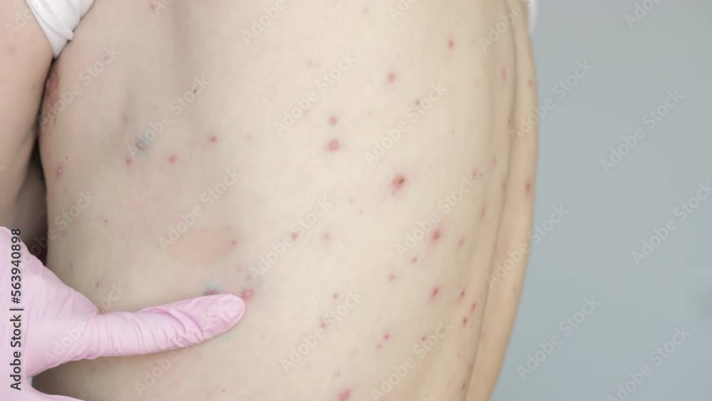 Body of adult man have spotted, red pimple and bubble rash from ...
