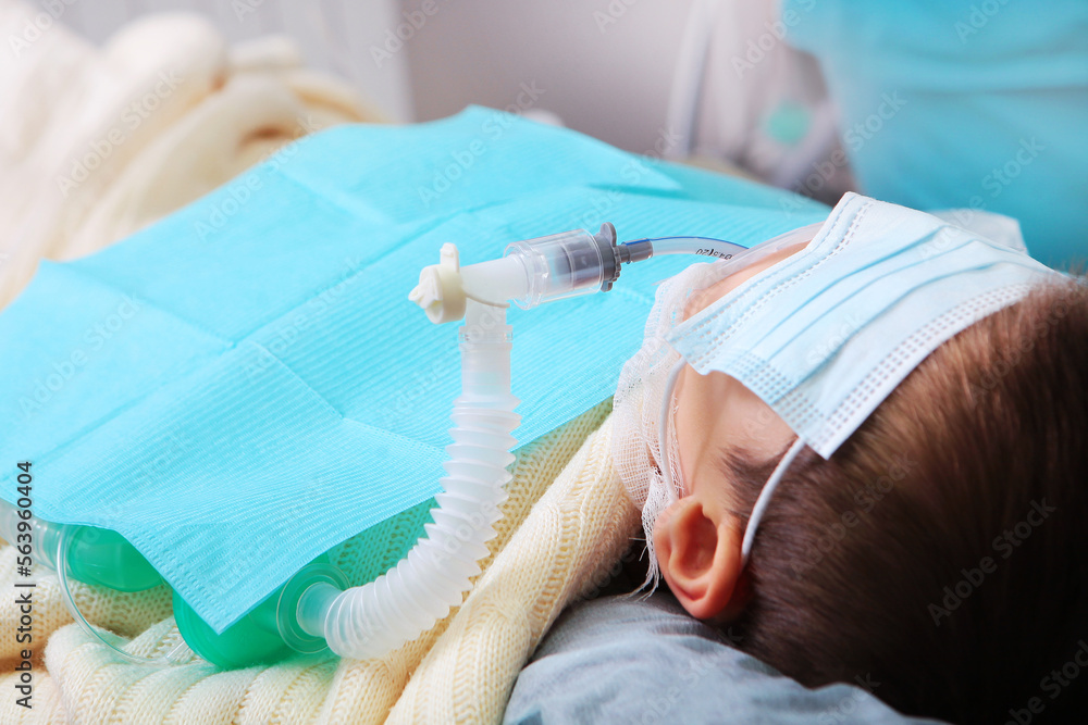 Little boy is under general anesthesia. A breathing tube in the baby's ...