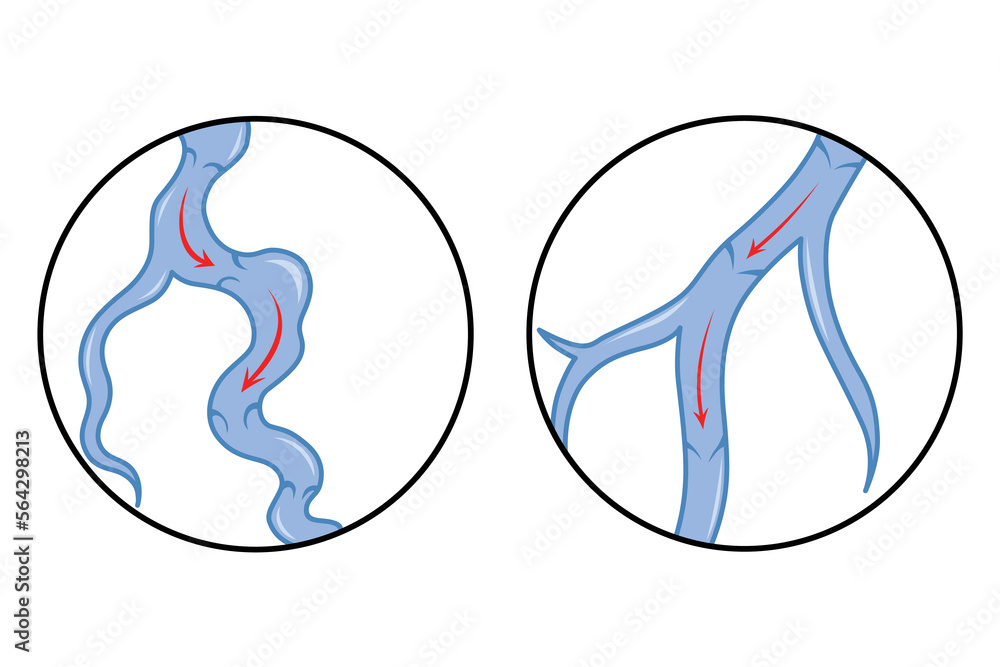 Varicose veins. Blue blood vessel visible through the skin. Vascular ...