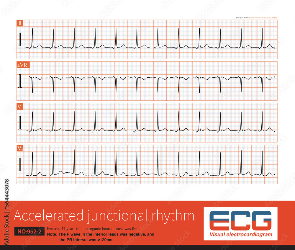 Sometimes, the frequency of coronary sinus will exceed the sinus node ...