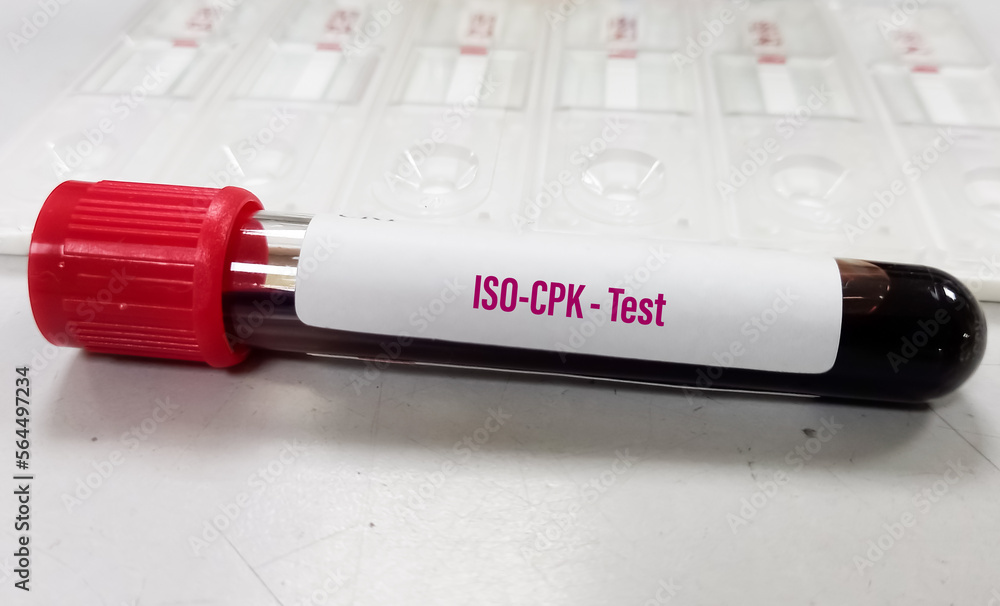 Blood sample for ISO-CPK (isoenzyme of creatinine phosphokinase) enzyme ...