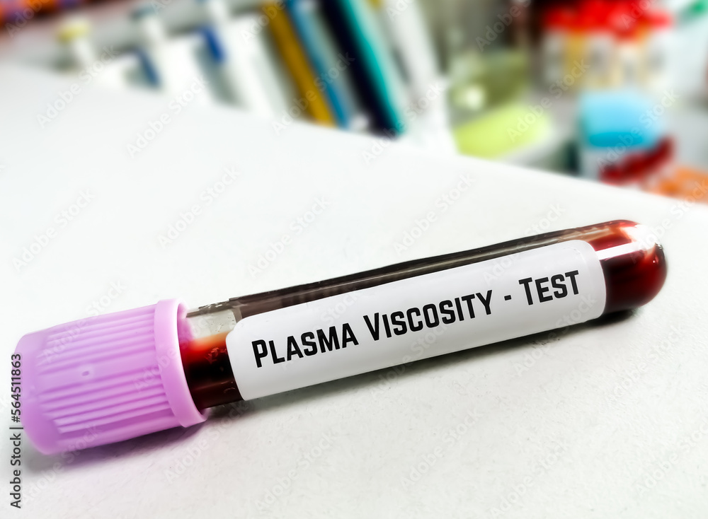 Blood sample for Plasma Viscosity test, Diagnosis for Polymyalgia ...