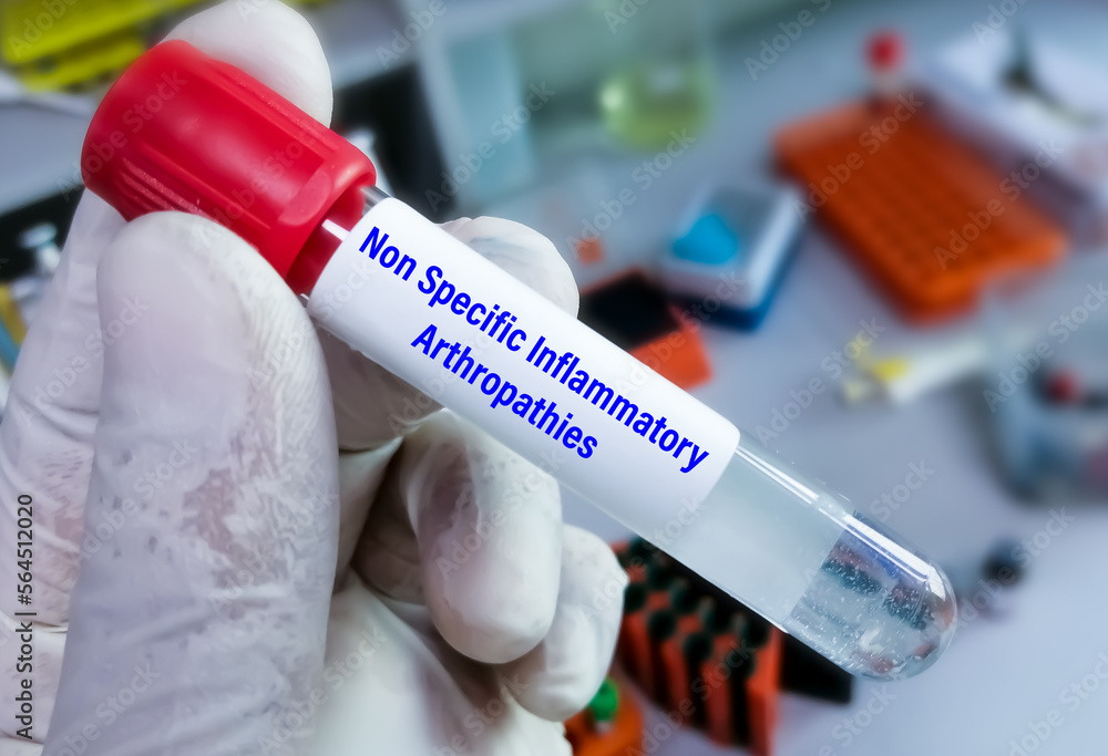 Synovial fluid analysis for Non Specific Inflammatory Arteriopathies or ...