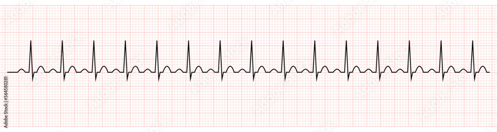 EKG Showing Sinus tachycardia of Patient Stock Vector | Adobe Stock