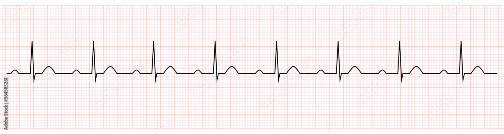 EKG Showing PR prolong which is Sign of First degree AV Block Stock ...