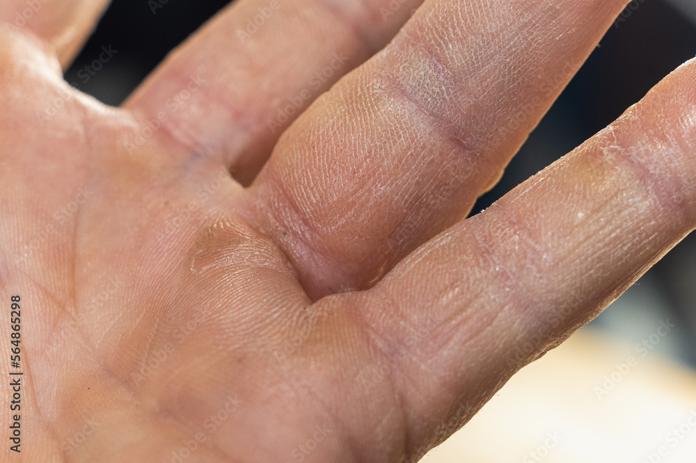 Foto de rash on fingers dyshidrotic eczema do Stock | Adobe Stock