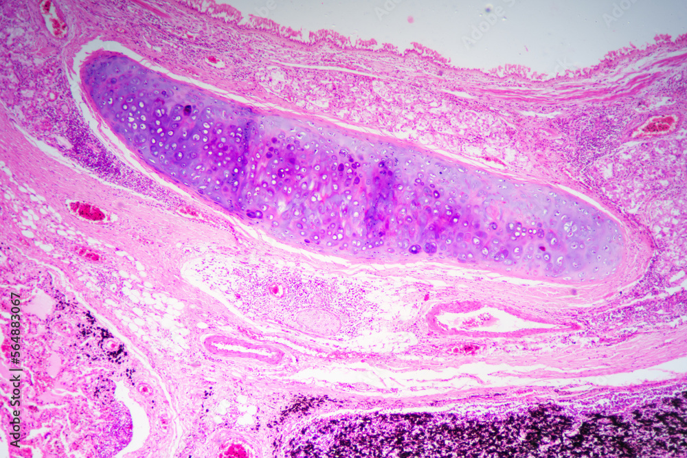 Chronic bronchitis disease human cells Stock Photo | Adobe Stock