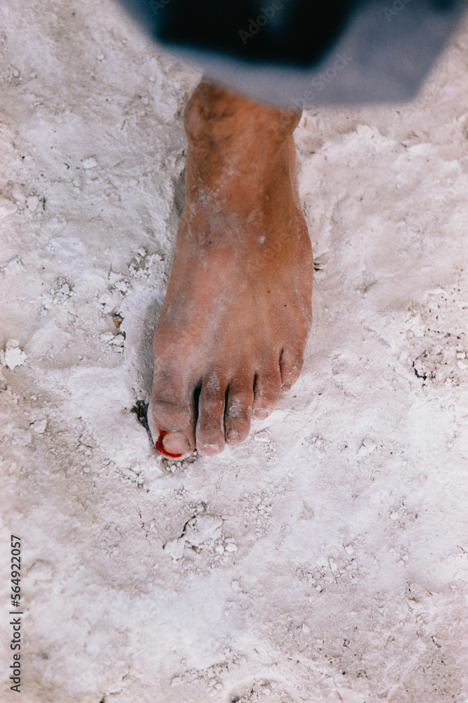 Bleeding Toe on Hippie Trail Stock Photo | Adobe Stock