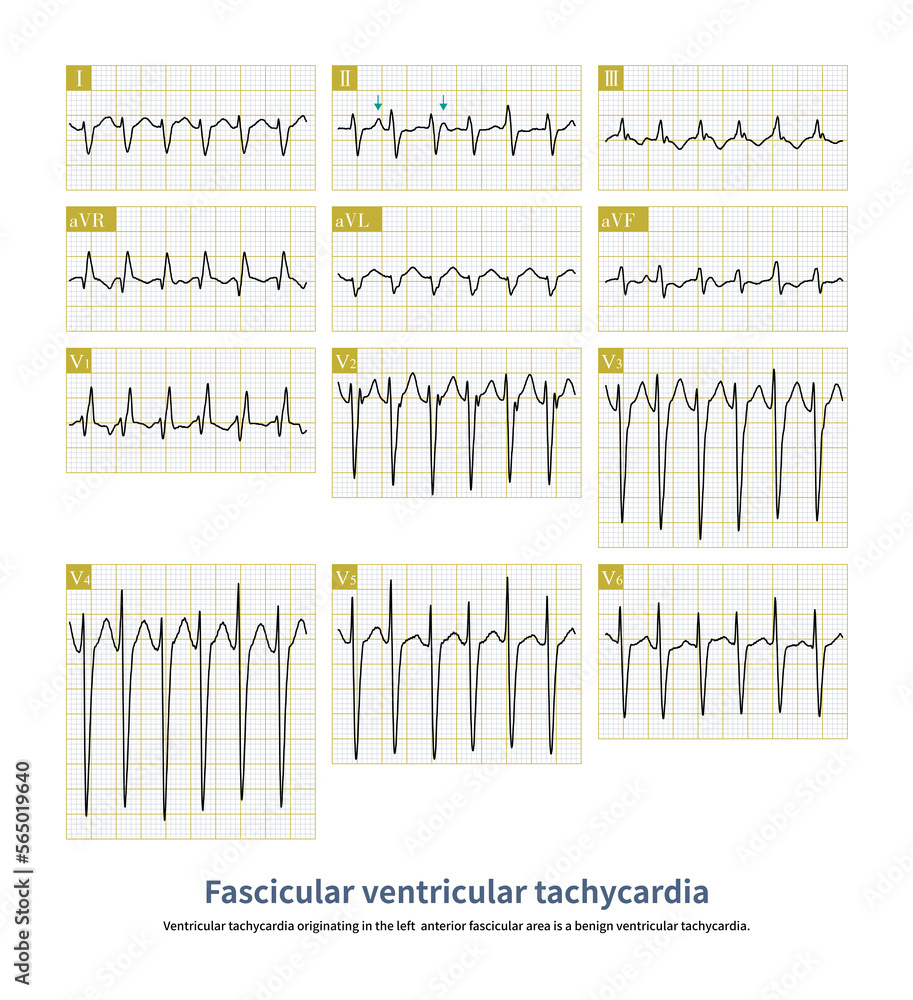 Idiopathic ventricular tachycardia, if originating from the left ...