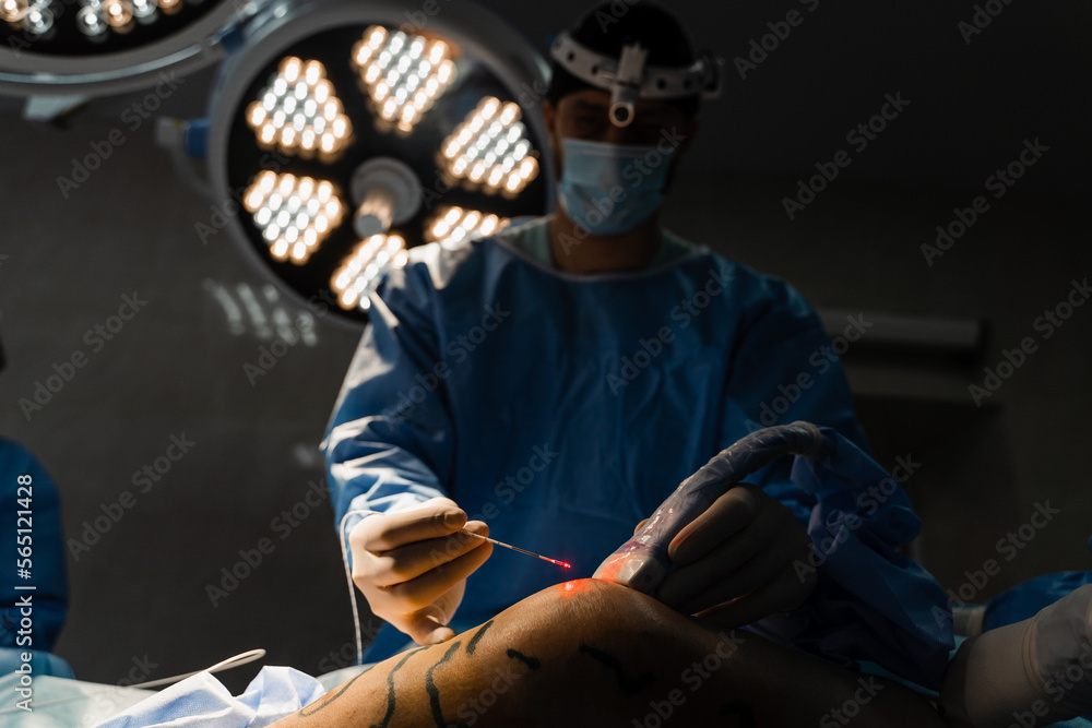 Endovenous laser coagulation for treatment varicose veins. Vascular ...