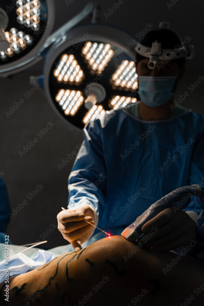 Endovenous laser coagulation for treatment varicose veins. Vascular ...