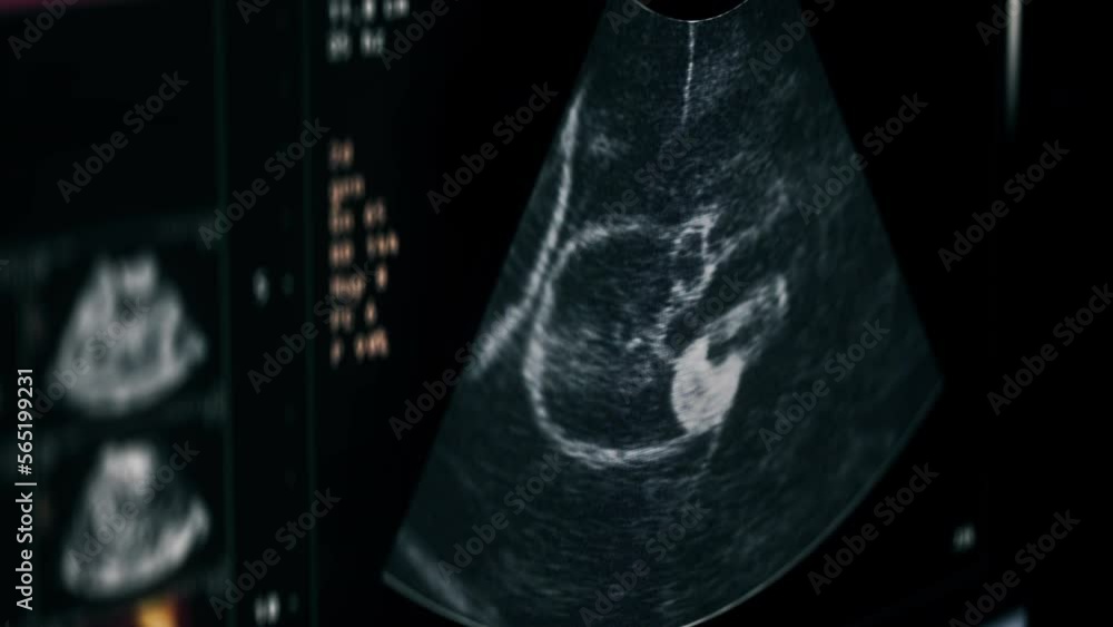 Ultrasound examination device checking the baby gender. Ultrasound ...