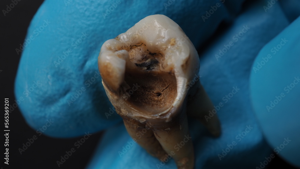 Tooth decay and dentist hand with glove and black background. Macro ...