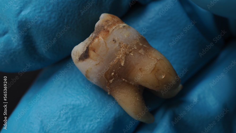 Tooth decay and dentist hand with glove and black background. Macro ...