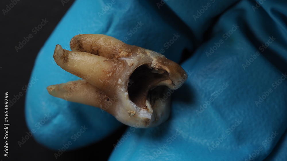 Tooth decay and dentist hand with glove and black background. Macro ...