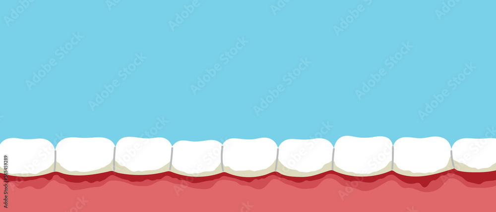 Gum disease cartoon banner. Periodontitis, gum bleeding, plaque on the ...