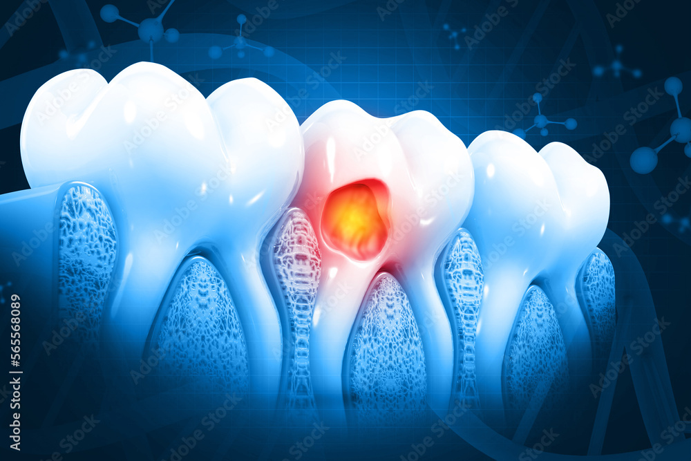 Tooth decay, dental caries formation detailed diagram, dental disease ...
