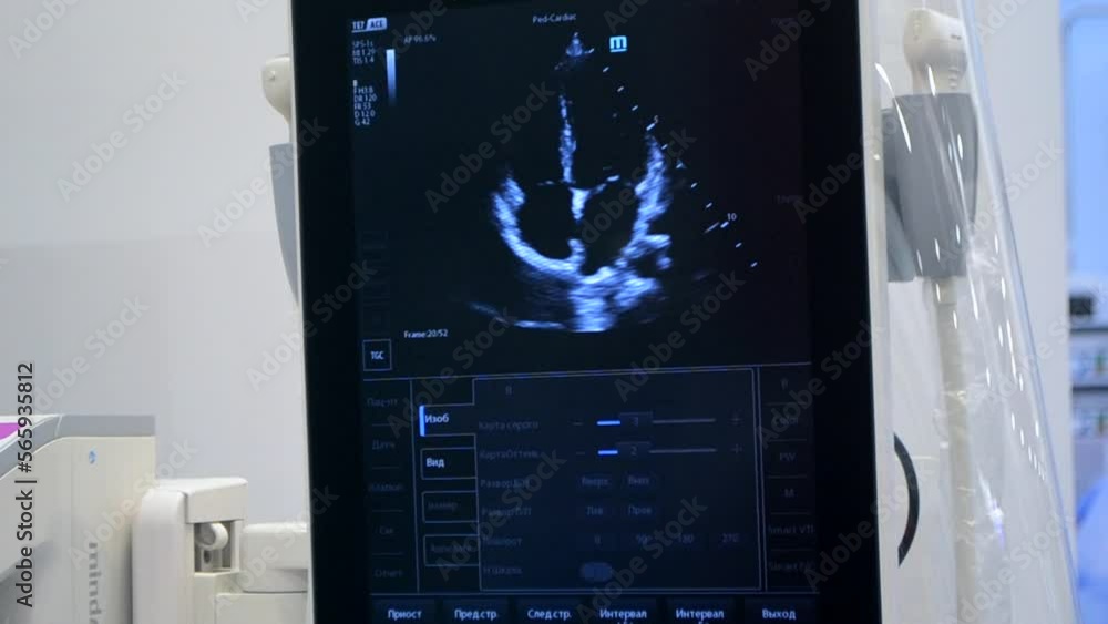 Utrasound image on the monitor close-up. Ultrasound Scan display ...