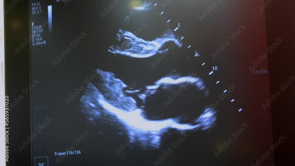 Vidéo Stock Utrasound image on the monitor close-up. Ultrasound Scan ...