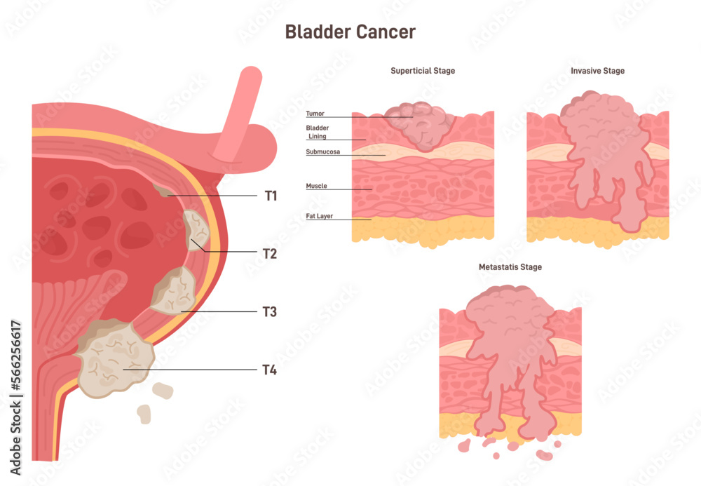 Stages of bladder cancer. Human internal organ wall with a developing ...