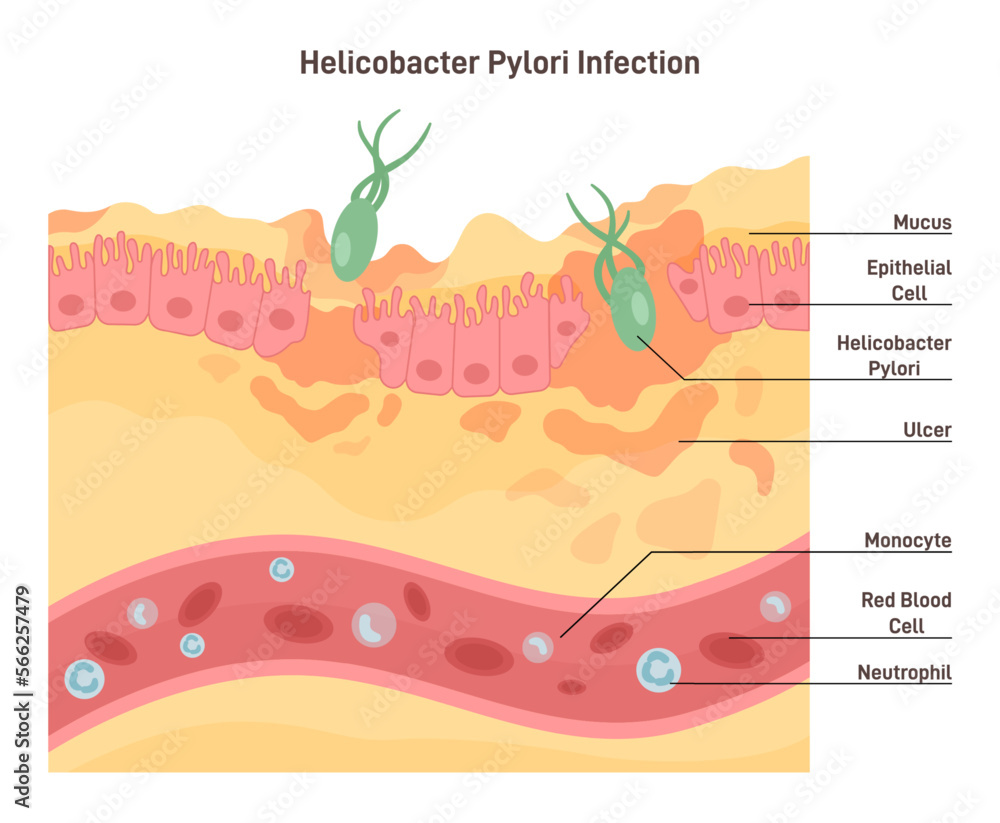 Helicobacter pylori infection. Bacterium with flagella damage the ...