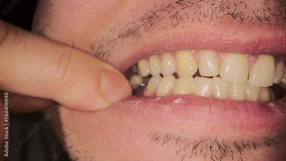 Bearded male patient shows result of tooth implantation in modern ...