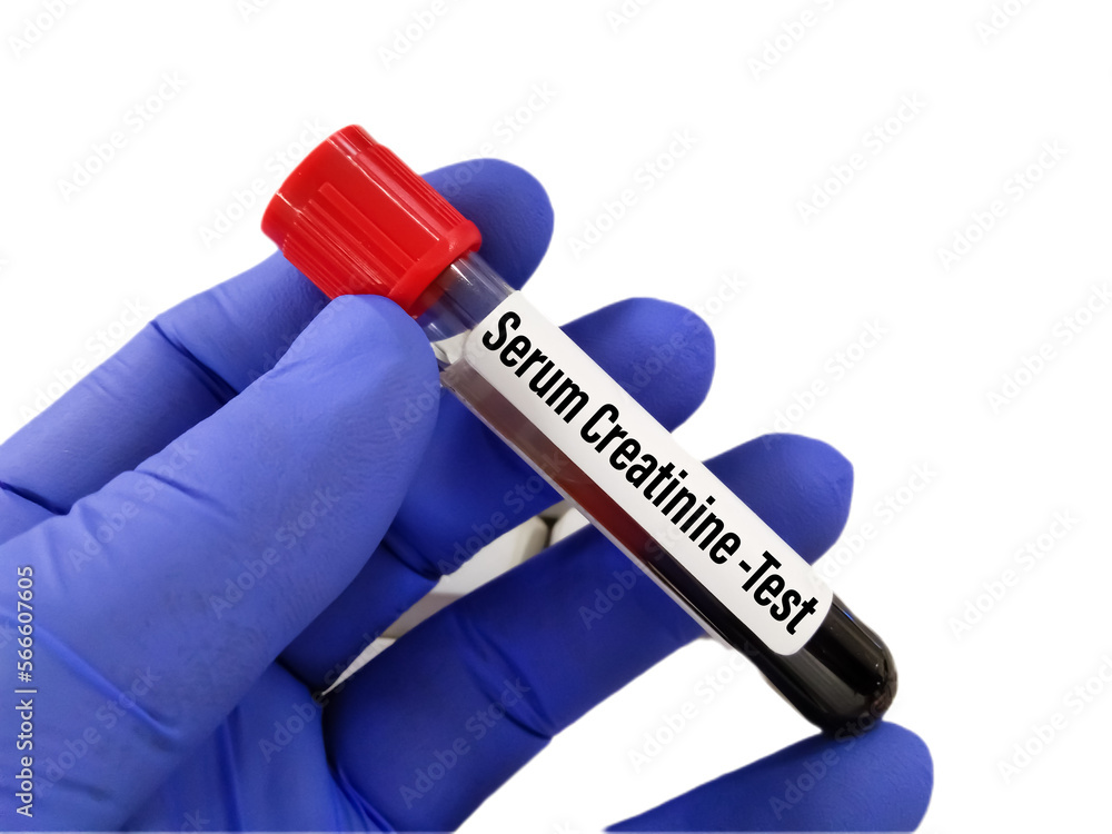 Blood sample for Serum Creatinine and Urea test. Copy space on colour ...