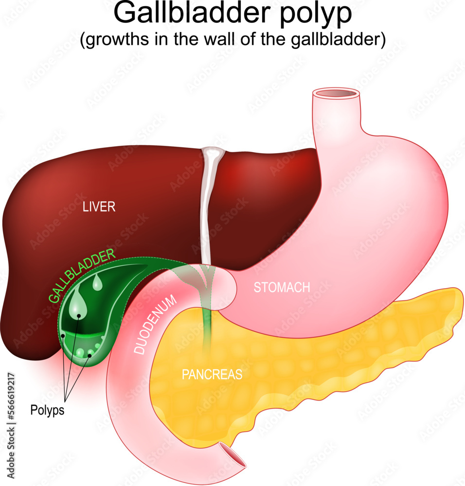Cross section of a Gallbladder with polyps Stock Vector | Adobe Stock