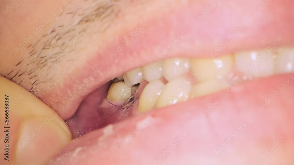 Man tries to open mouth wide to show black threads put on gum after ...