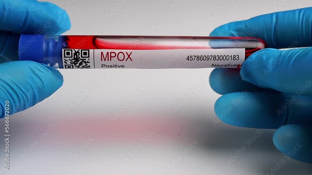 flasks with blood tests for coronavirus positive and negative, mpox ...